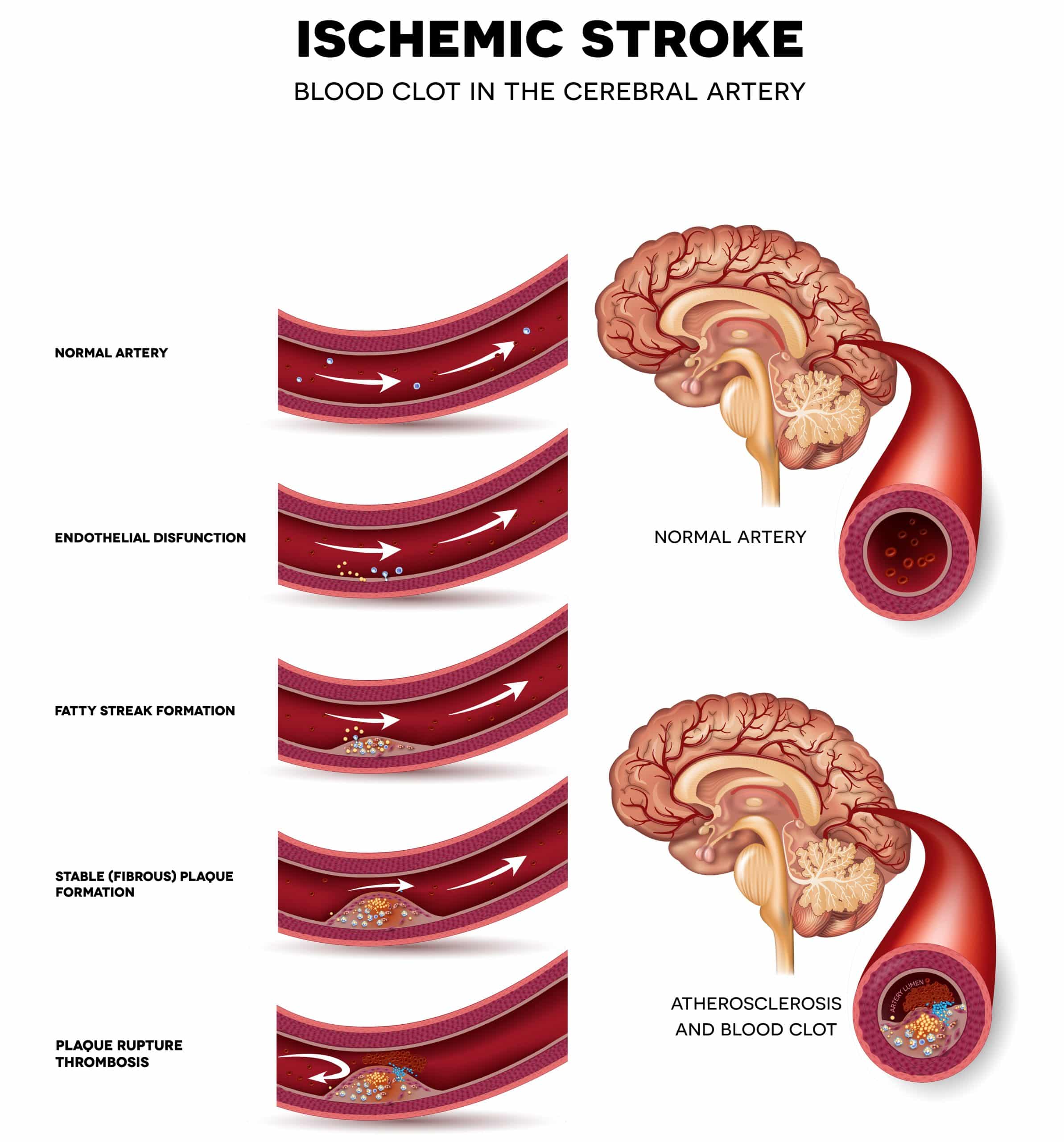 What You Should Know About Ischemic Stroke - Garcia & Artigliere ...