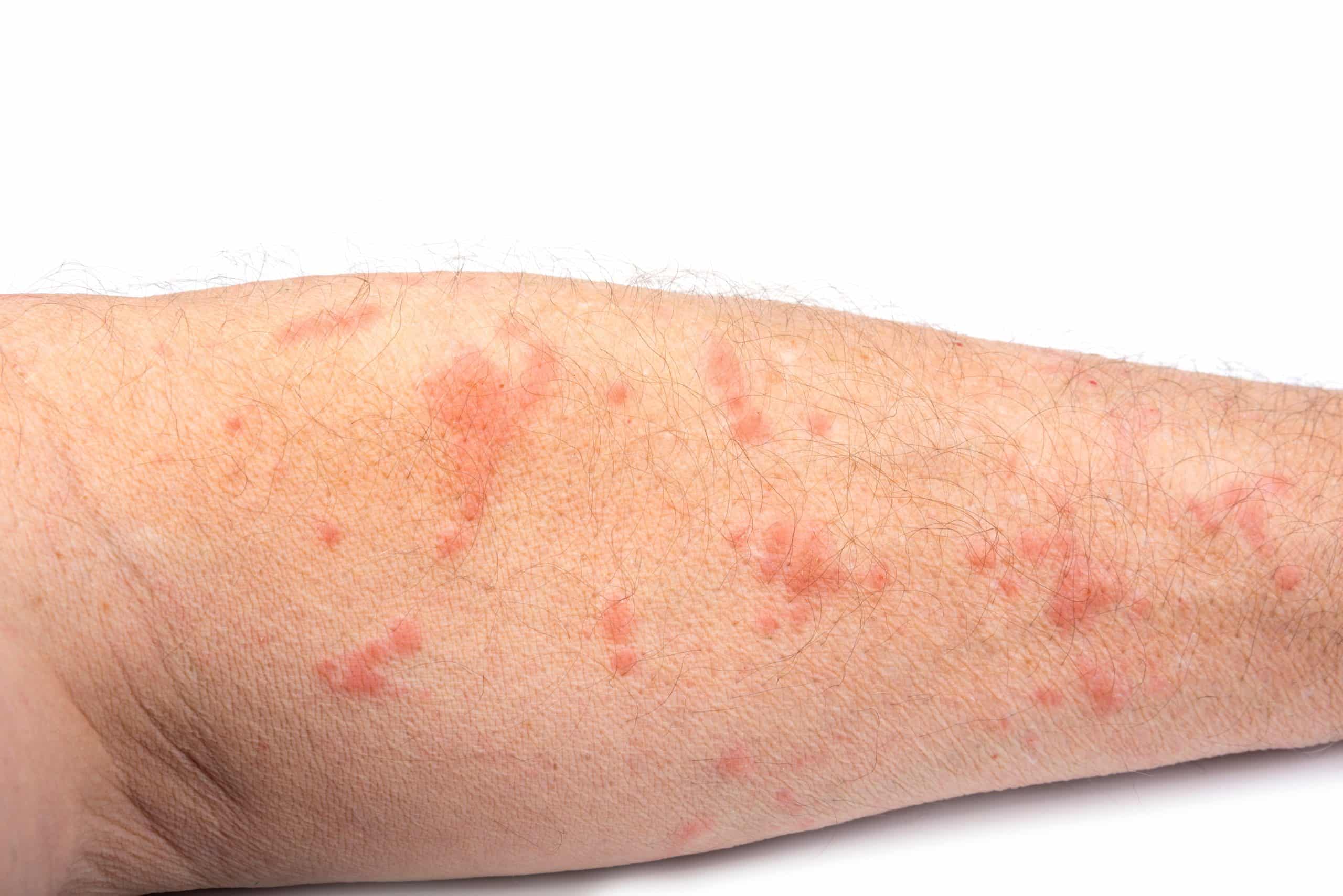 Scabies Is a Sign of Nursing Home Neglect - Garcia & Artigliere ...