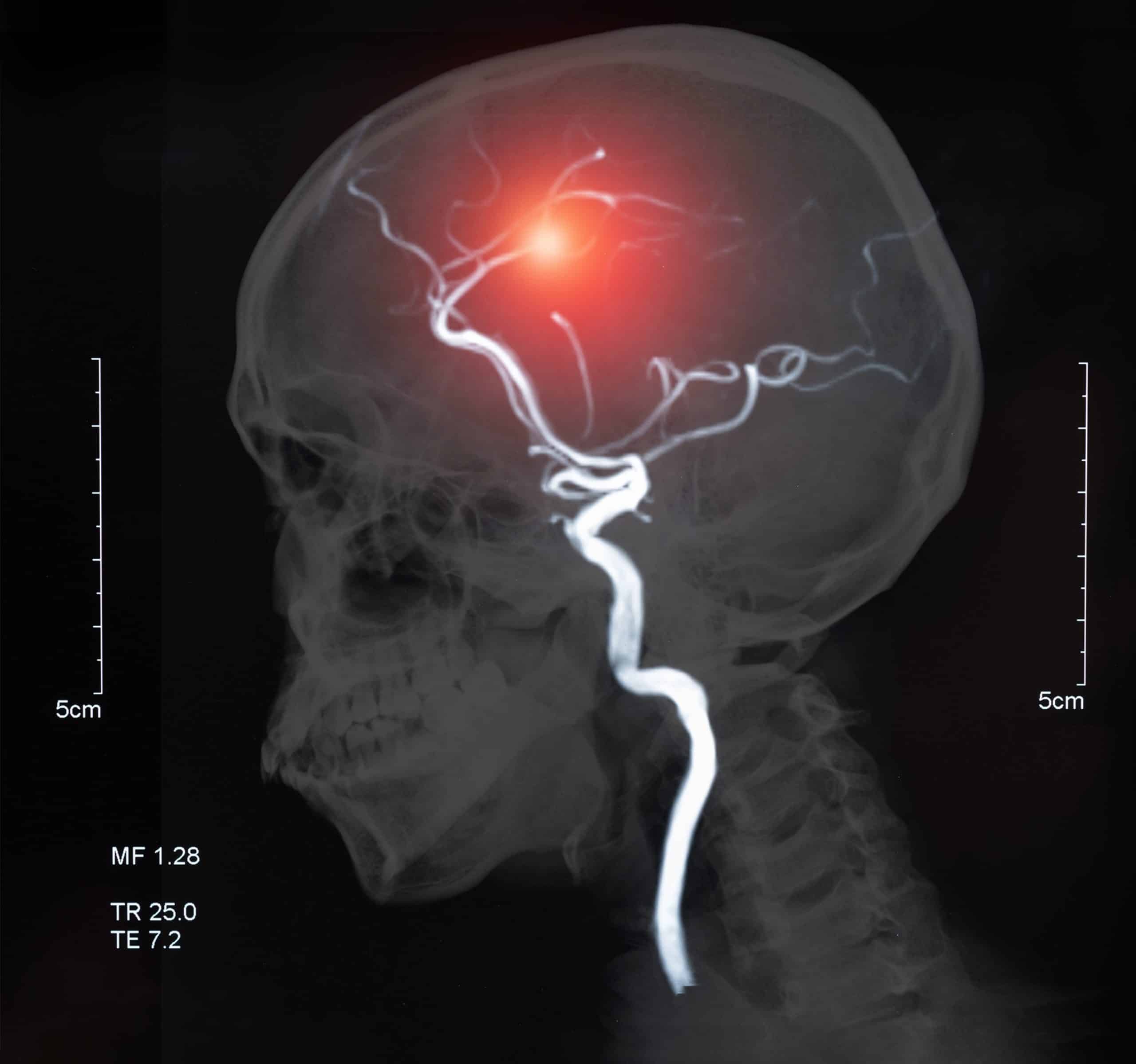 A New Worry About Falling and Hitting Your Head: A Higher Risk of ...